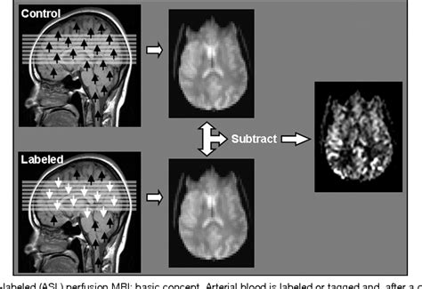 Figure 1 From Clinical Neuroimaging Using Arterial Spin Labeled