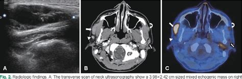 Figure 2 From A Case Of Mucosa Associated Lymphoid Tissue Lymphoma
