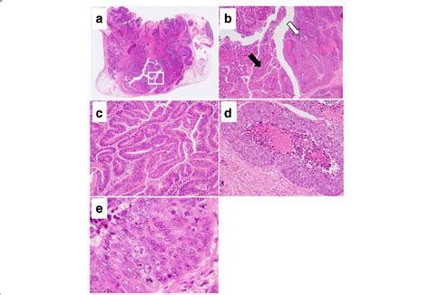 Pathologic Examination Of The Resected Specimen Stained With