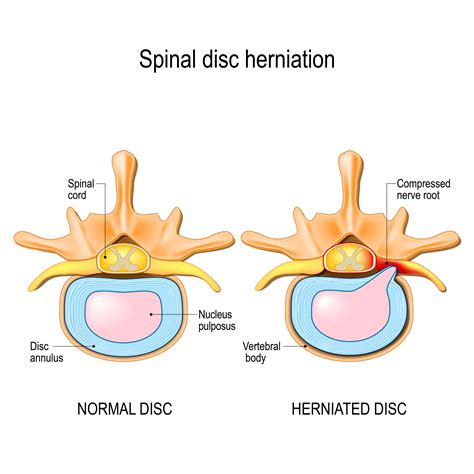 Physical Therapy For Herniated Discs How Can It Help