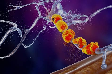 Motor Neuron Disease Types Symptoms Causes Diagnosis And Treatment At