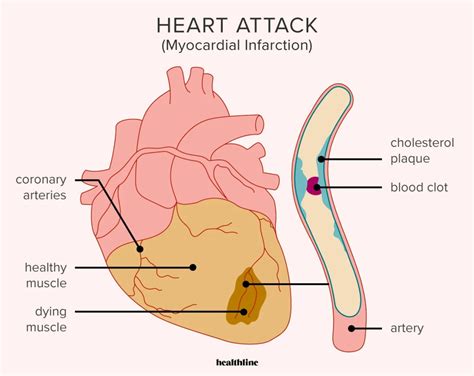 Heart Attack Symptoms Causes Diagnosis Prevention More