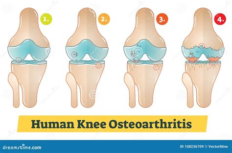 Human Knee Osteoarthritis Diagram Illustration Stock Vector