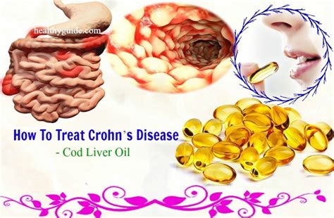 10 Tips How To Treat Crohns Disease With Natural Remedies And Diet At Home