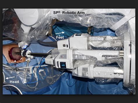 Pure Single Site Robot Assisted Partial Nephrectomy Using The Sp