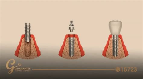 مراحل زراعة الاسنان الموقع الرسمي لعيادات Guarantee Dental