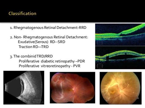 Rhegmatogenous Retinal Detachment Rrd