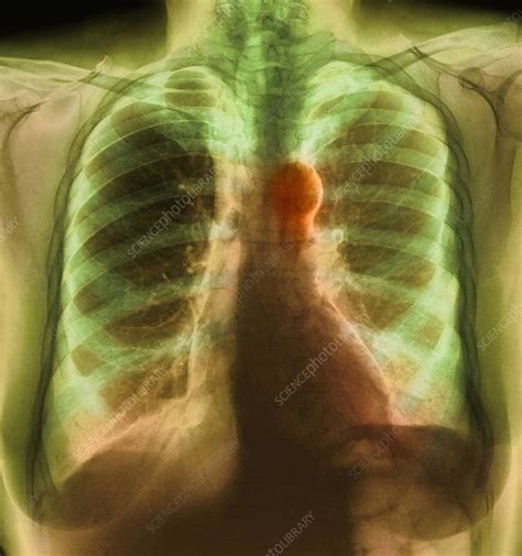 Aortic Aneurysm X Ray Stock Image C010 3511 Science Photo Library