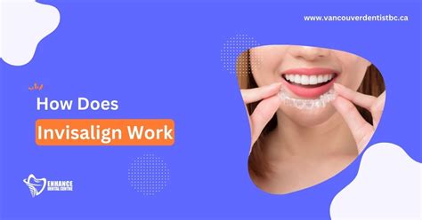 The Complete Guide On How Invisalign Works Enhance Dental Ca