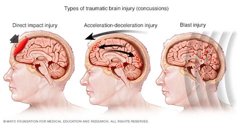 Concussion Beacon Health System