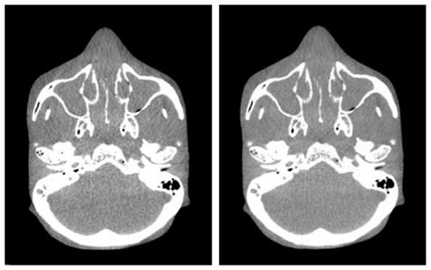 Reconstructed Images From Real Helical Cone Beam Data By Use Of The Fdk