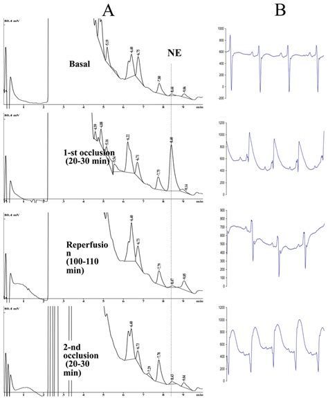 Chromatograms Of Myocardium Dialysate A And Electrocardiograms B