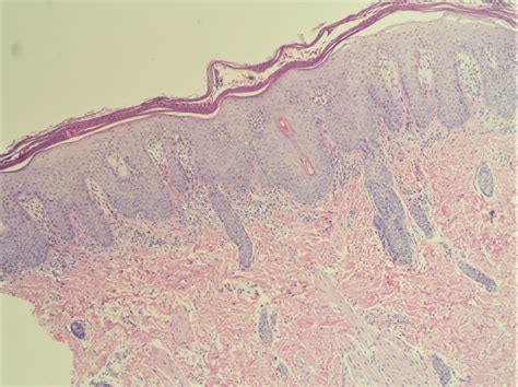 Light Microscopy Showing Psoriasiform Dermatitis H‐e 100× Download