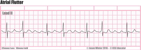 Atrial Fibrillation Vs Atrial Flutter Ecg