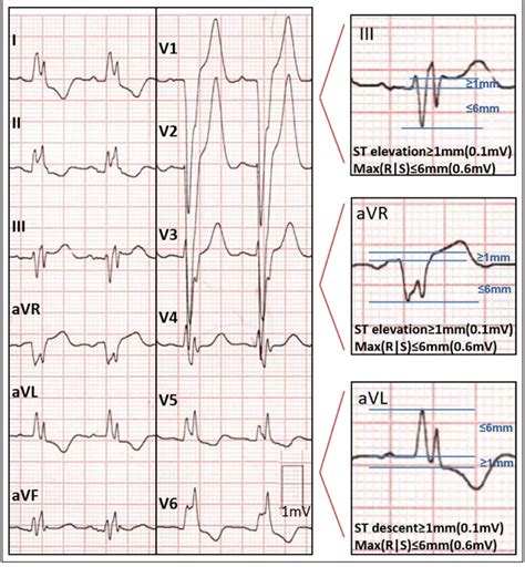 Ecg From A Patient With Acute Myocardial Infarction And Culprit Artery