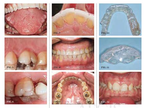 Figure 6 From The Bruxism Triad Sleep Bruxism Sleep Disturbance And
