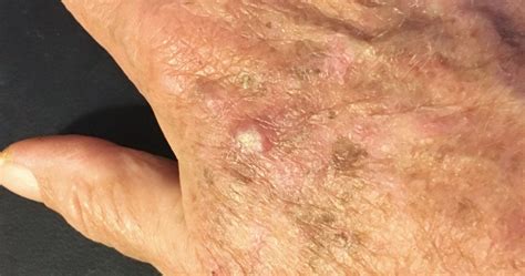 What Causes Seborrheic Keratosis