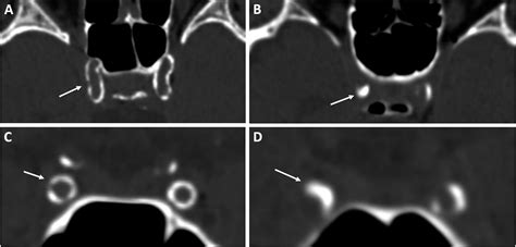 Intracranial Carotid Artery Calcification Subtype And Collaterals In
