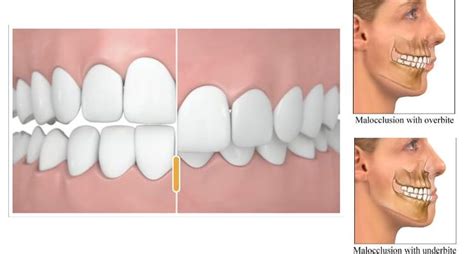 How To Correct Overbite Without Braces Correcting Overbite Overjet
