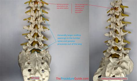 Lumbar Thoracic Epidural Catheter Insertion Technique And Overview