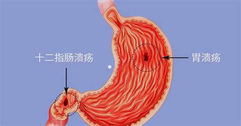 如何分辨胃潰瘍、十二指腸潰瘍！如何飲食調理和治療？ 每日頭條