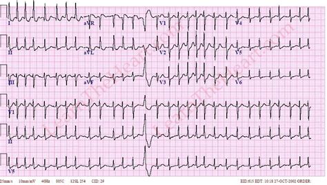 atrial fibrillation with rapid ventricular rate ecg example 5 learn