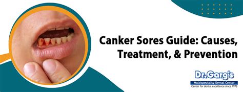 Canker Sores Causes Treatment And Prevention Guide