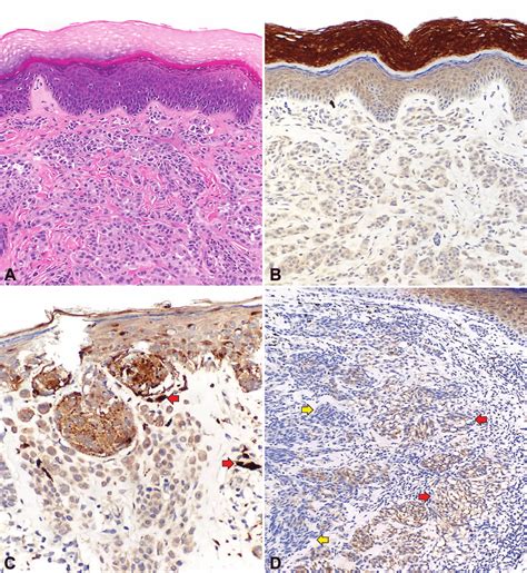Telomerase Reverse Transcriptase Tert Expression In Nonlentiginous