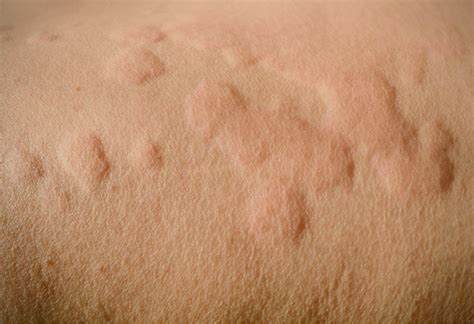 Abordaje De La Urticaria Atención Primaria