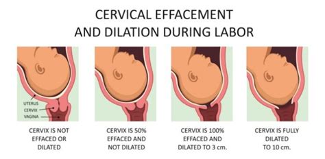 Common Methods Of Inducing Labor During Pregnancy Medika Life