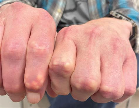 Finger Nodules Tip Of The Gouty Iceberg Cleveland Clinic Journal Of