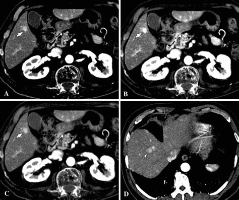 A–d Contrast Enhanced Ct Images Obtained During Arterial Phase With