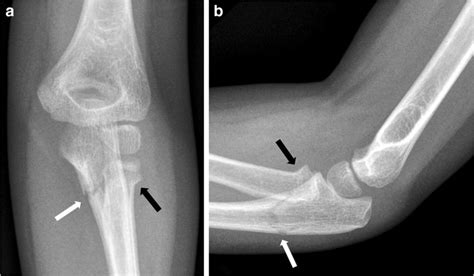 Proximal Ulnar Metadiaphysis And Proximal Radius Fractures Initial