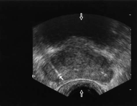 Technique For Implantation Of Fiducial Markers In The Prostate Urology