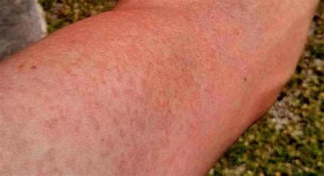 Tanning Bed Burn Rash