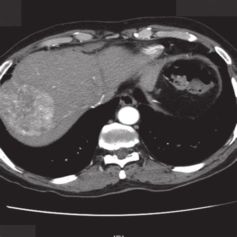 Triphasic Ct Scan Of The Abdomen Showing A Liver Mass At Segment 5 And