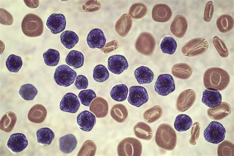 Acute Lymphoblastic Leukemia Bone Marrow Smear Stock Illustration