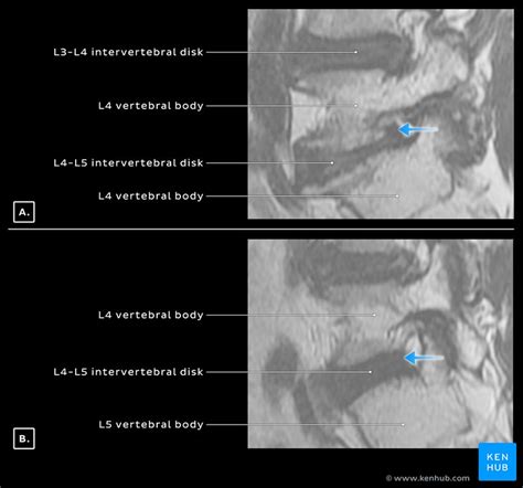 Radiculopathy And Surgery Anatomical Considerations Kenhub