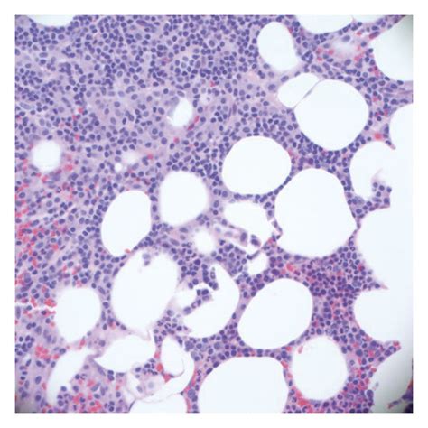 Hypercellular Bone Marrow With Aggregates Of Mast Cells Download