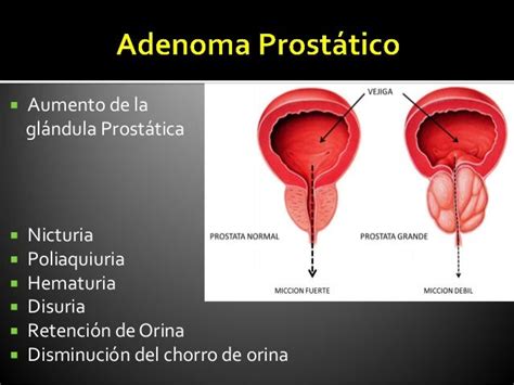 Adenoma Prostático O Hpb
