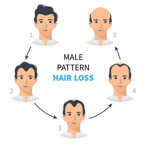Hair Loss Stages Androgenetic Alopecia Male Pattern Steps Of Baldness