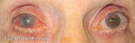 Atlas Entry Acute Angle Closure Glaucoma