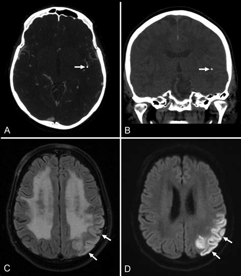 Ct Angiography In Evaluating Large Vessel Occlusion In Acute Anterior