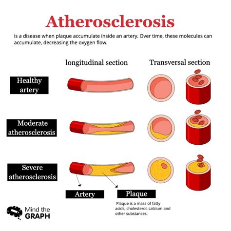 Understanding Atherosclerosis Through Medical Illustrations Mind The