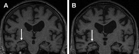 White Matter Lesions Are Associated With Progression Of Medial Temporal