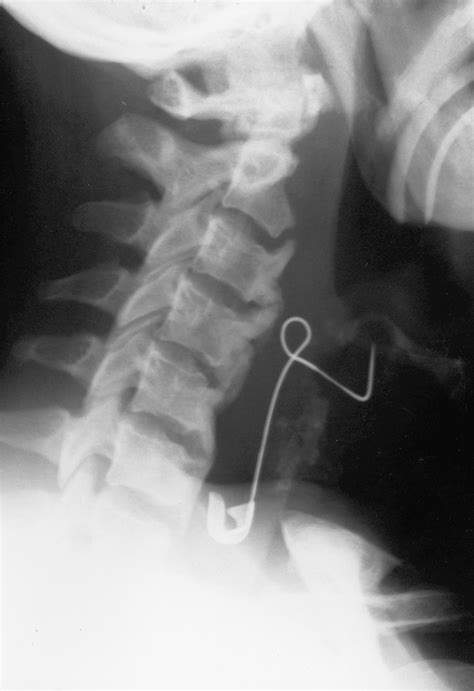 10 Foreign Bodies Radiology Key