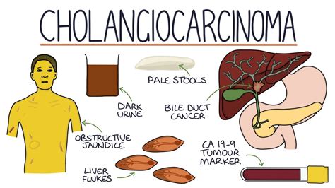 Understanding Cholangiocarcinoma Youtube