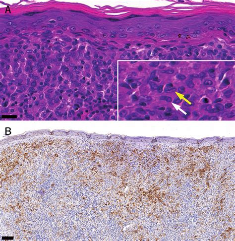 A Punch Biopsy Revealed A Well Defined Grenz Zone And A Dense Dermal