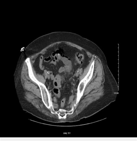 Computerized Tomography Of Abdomen And Pelvis Download Scientific