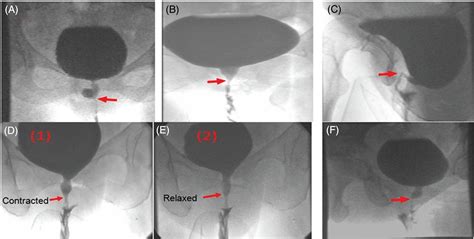 Female Bladder Outlet Obstruction Common Symptoms Masking An Uncommon